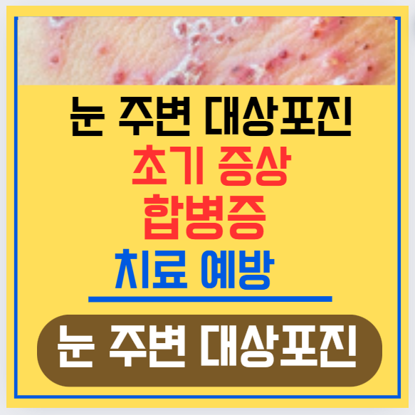 눈 주변 대상포진 초기 증상 합병증 치료 예방