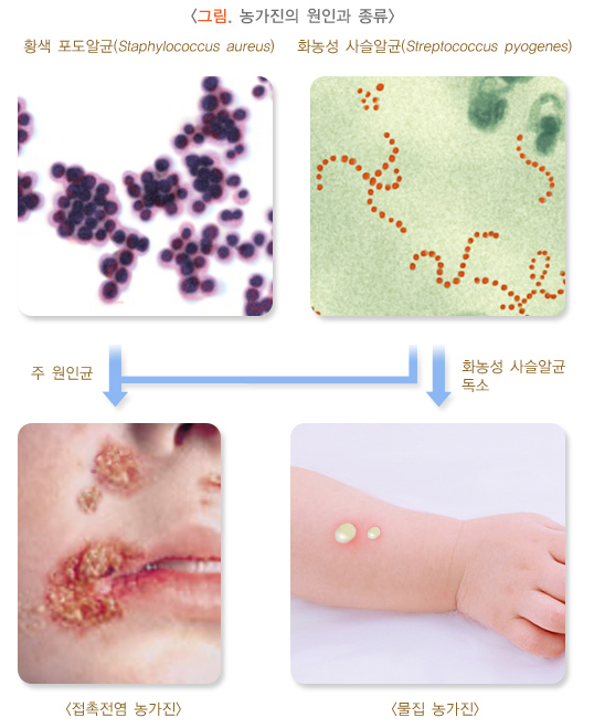농가진 증상 원인 전염 치료방법 총정리 예방법