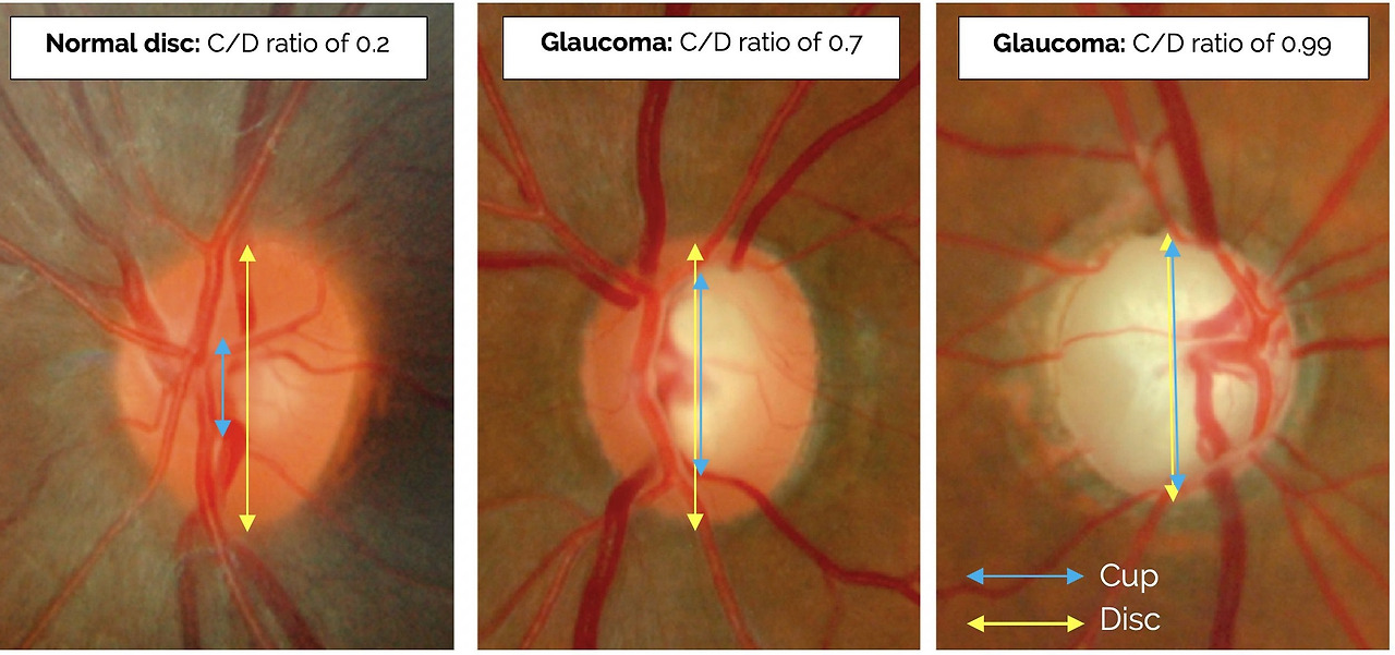 녹내장 가능성이 높거나 의심해야할 시신경유두 소견, 녹내장 진행을 나타내는 소견.