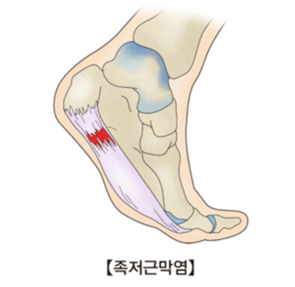 족저근막염 증상 및 관리방법 알아보기
