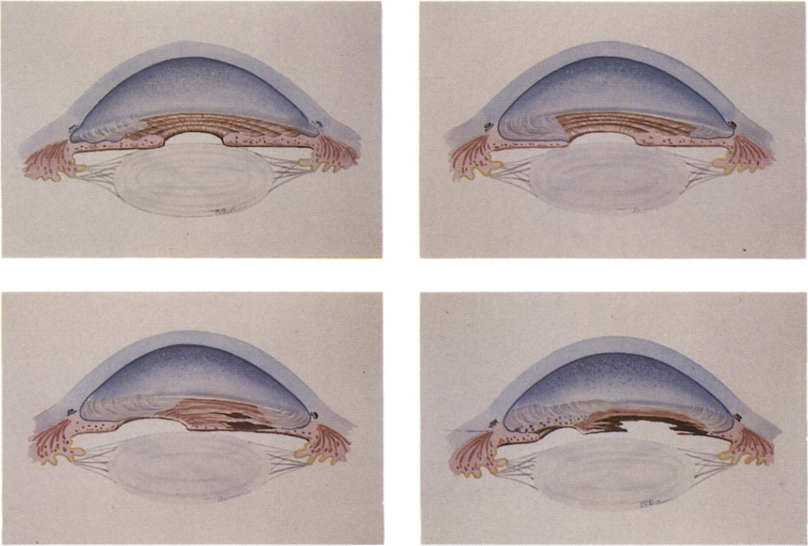 홍채각막내피증후군 (ICE syndrome, iridocorneal endothelial syndrome)과 코간리즈(Cogan ...