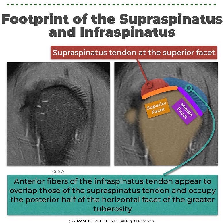 [Shoulder_01] Rotator cuff footprint, supraspinatus, and infraspinatus ...
