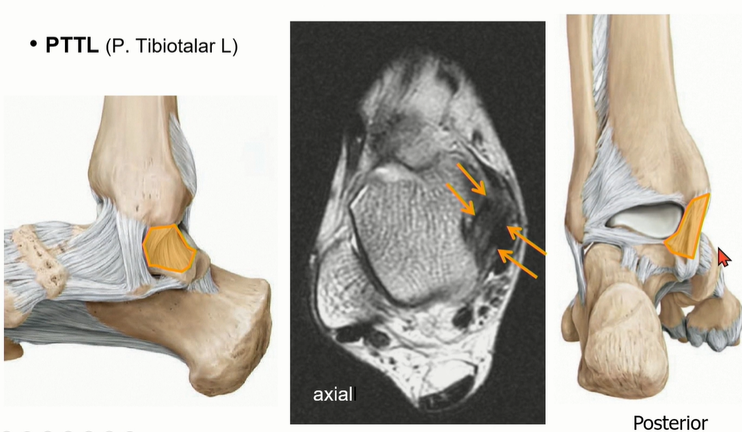 발목 MRI 공부_Ankle ligaments