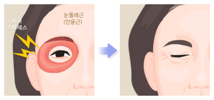 눈밑 떨림 원인 눈꺼풀 떨림현상 원인과 해결방법 7가지