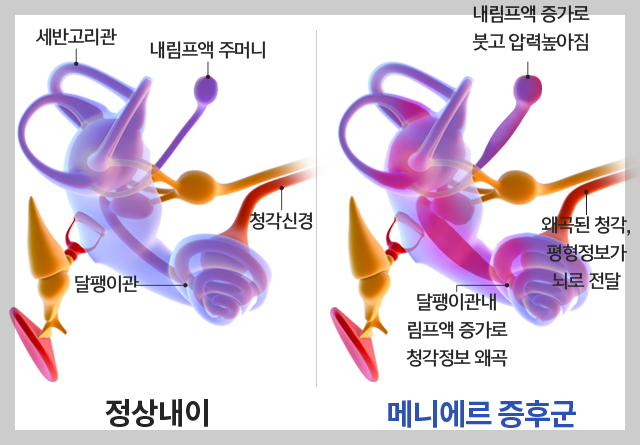 메니에르 증상 원인 치료 이석증과 차이점은
