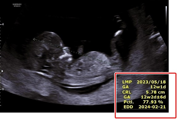 산부인과 태아 초음파 용어 알아보기 (LMP, GA, EDD, CRL, FL, EFW 등)