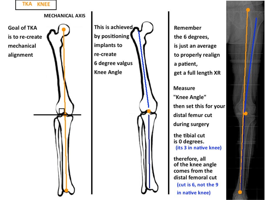 [TKA] 인공 관절 전치환 수술 후 다리 정렬 (TKA alignment)