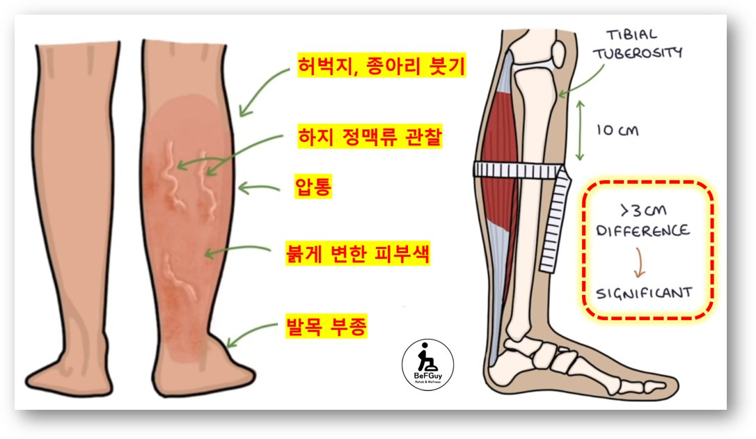심부정맥혈전증 다리에 생긴 피떡 이코노미클래스 증후군 종아리 허벅지 운동법은