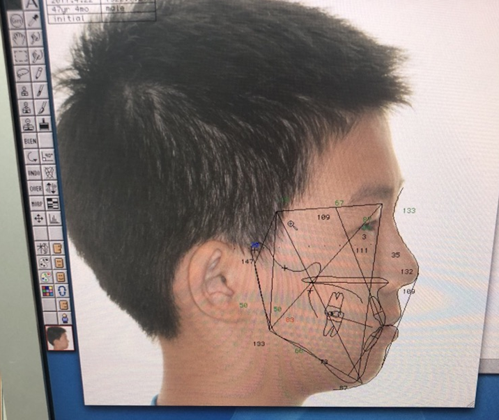 치아교정 비용부터 후회사례까지 시작 전 반드시 알아야 할 모든 것