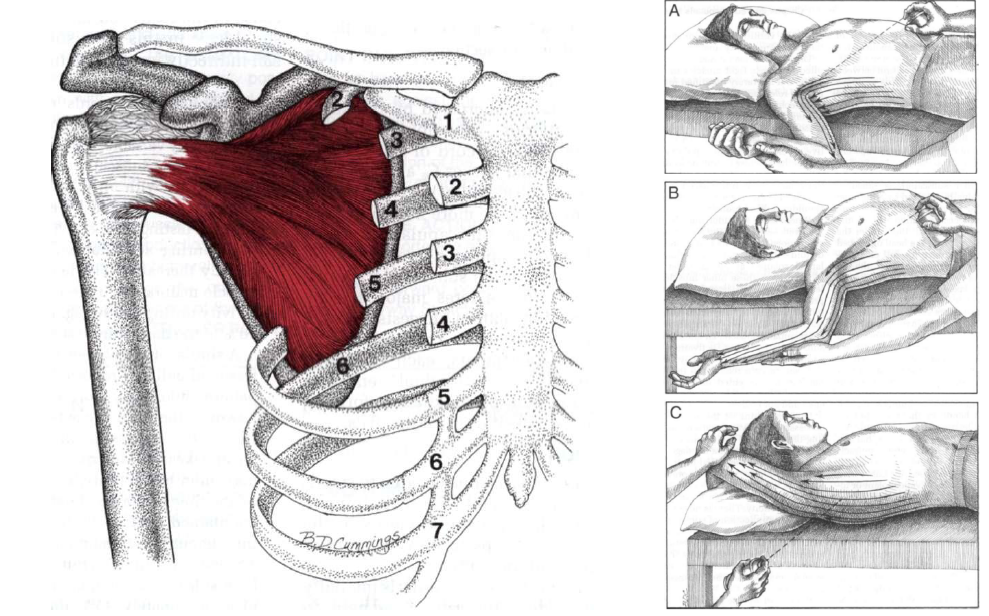 견갑하근(Subscapularis) 통증유발점과 연관통(TrPs, Referred pain) :: MEMPT
