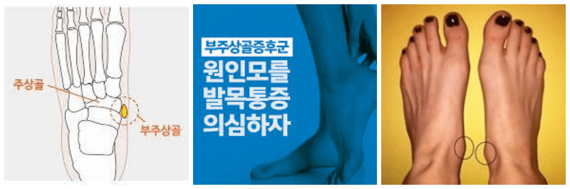 발목과 발바닥 안쪽의 통증을 유발하는 부주상골 증후군 원인 증상 검사 치료방법 수술