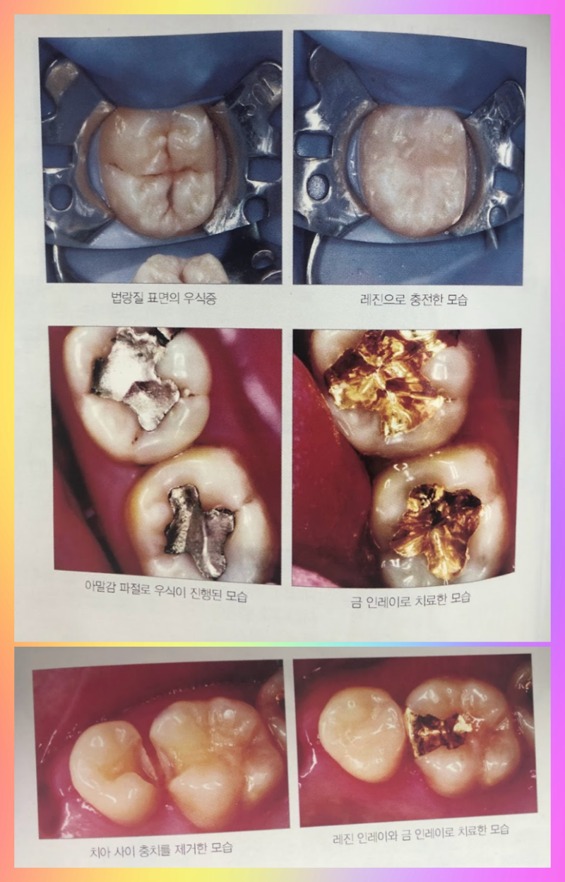 치아우식증caries 충치 증상 원인 단계별 치료방법 우유병 우식증 치료해야 하는 이유