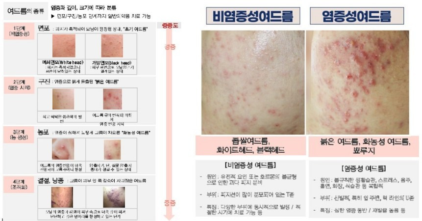 애크린겔 가격 성분 특징 사용법 주의사항부작용 애크논 크림과 차이점