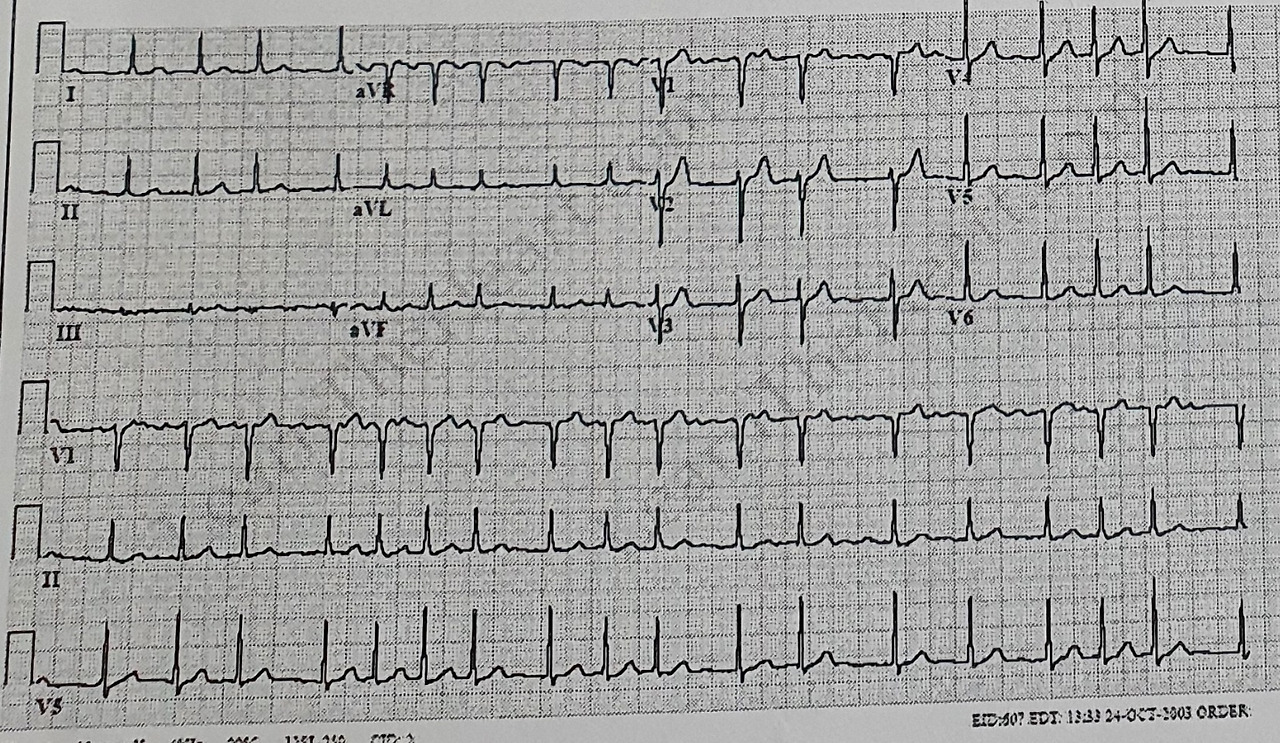 응급실 간호사라면 꼭! 알아야 하는 EKG rhythm(Asystole, PEA, VF, Pulseless VT, PSVT, A ...