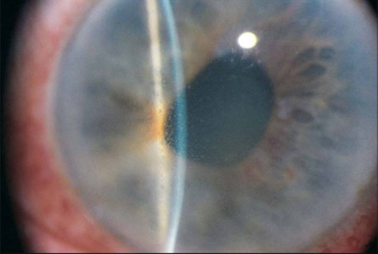 ICE syndrome, 챈들러 증후군(Chandler syndrome)과 진행성 홍채위축(Progressive ...