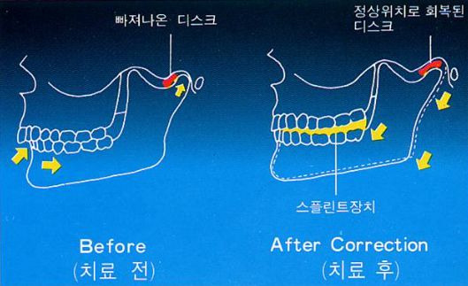 악관절턱관절이 아파요 통증치료 스플린트가격