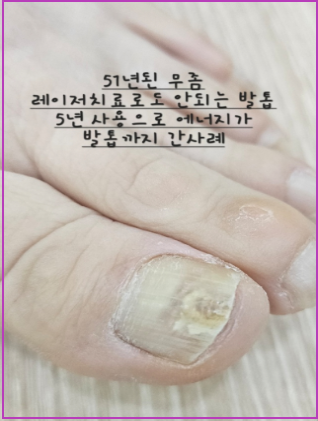 세이잠 51년 발톱 무좀