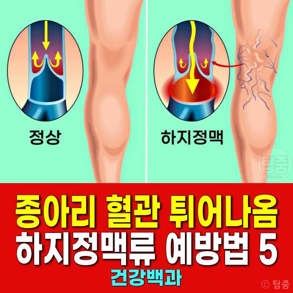종아리 혈관 튀어나옴 하지정맥류 증상 예방 5가지 방법