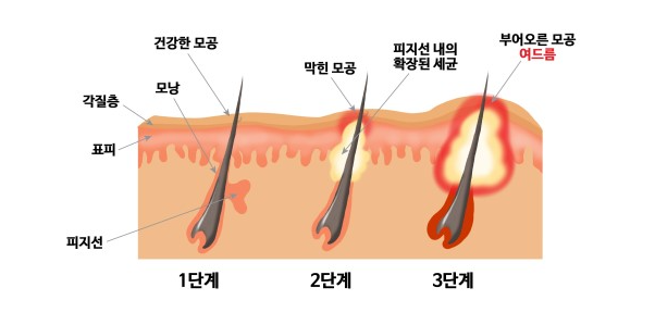 베아로반 연고 효과 효능 가격 사용법 부작용 주의사항모낭염 여드름