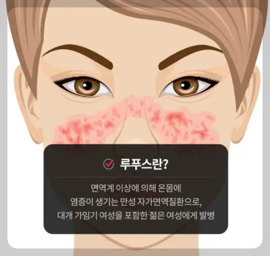 루푸스 원인과 증상 검사와 치료방법 가임기 여성 주의질환
