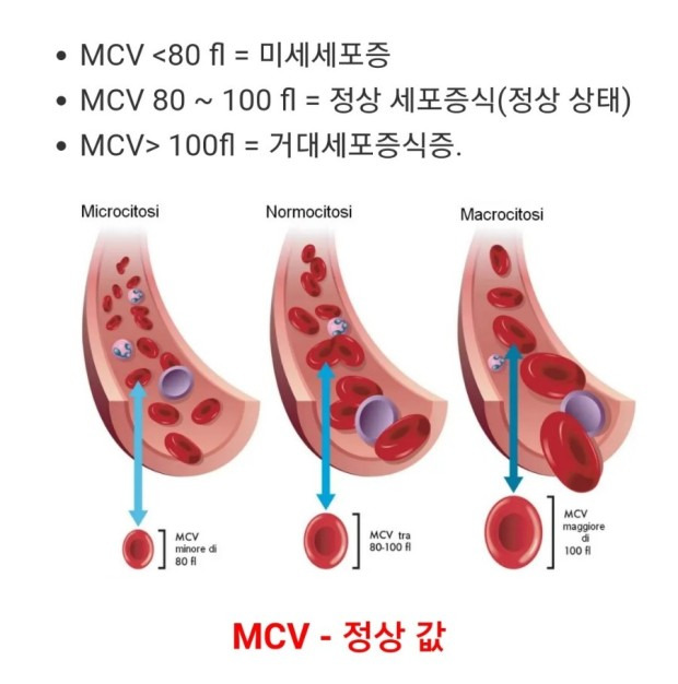 혈액검사RBC,Hb,HCT,MCV,MCHC,MCH,PLT에 따른 의심질환과 원인
