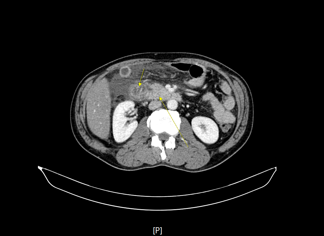 십이지장 천공duodenal Perforation으로 오인된 췌장염pancreatitis환자