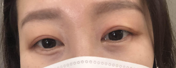 눈두덩이 알러지 눈꺼풀 빨갛게 부음 가려움 직접 해결한 방법 후기