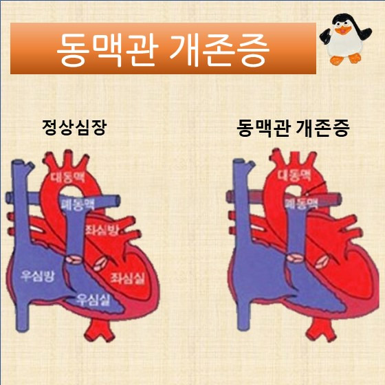 동맥관 개존증patent Ductus Arteriosus Pda 원인 증상 진단방법 검사방법 치료방법