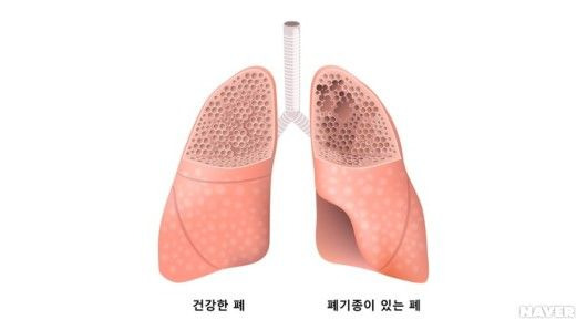(COPD) 만성 폐쇄성 폐질환 : 증상, 원인, 치료