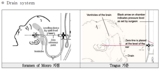 EVD (External Ventricular Drainage)