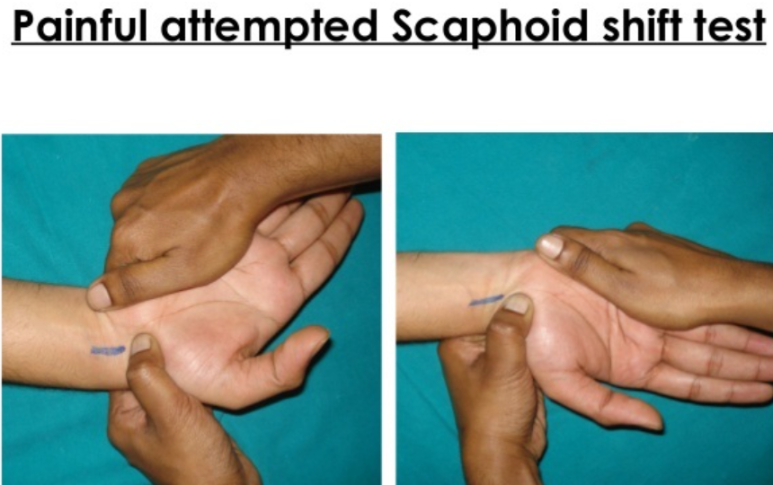 질병 손목뼈 주상골 골절scaphoid Fracture