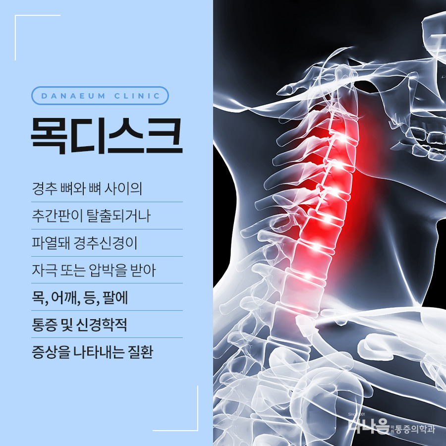 목디스크 증상 및 목디스크 치료방법 총정리 정보사냥꾼시즌2