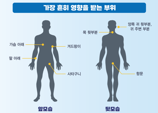 화농성 한선염 우리가 알지 못하는 희귀 질환