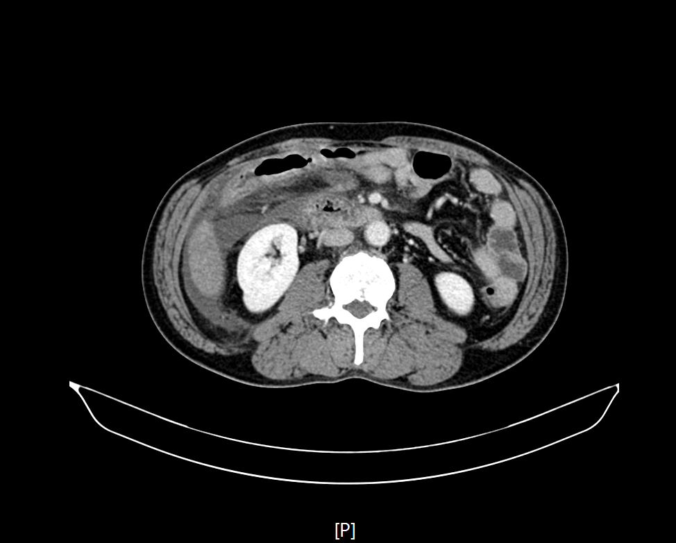 십이지장 천공duodenal Perforation으로 오인된 췌장염pancreatitis환자