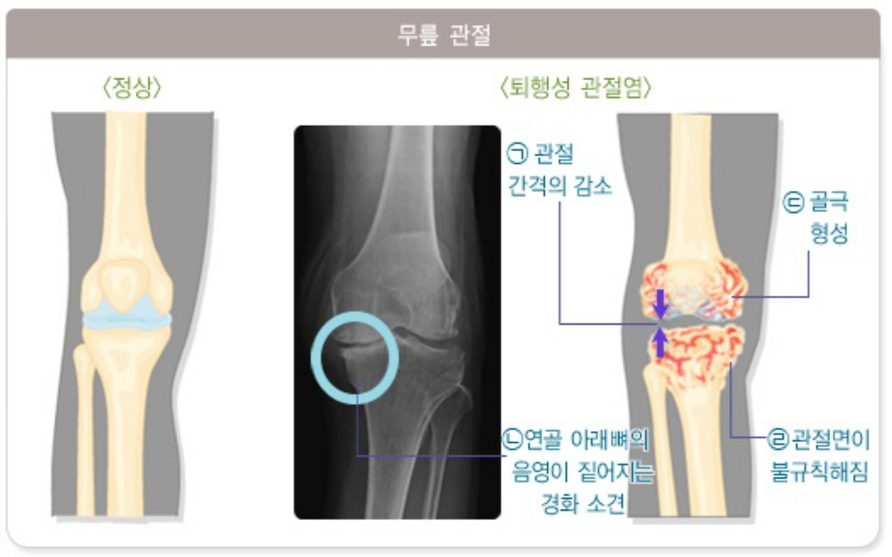골관절염 증상 및 골관절염 약 이모튼 캡슐 정보 확인하기