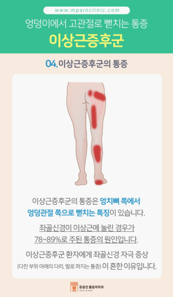 고관절통증 이상근증후군