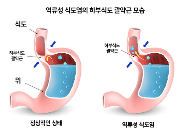 역류성 식도염의 원인 증상 및 치료 방법 올모드