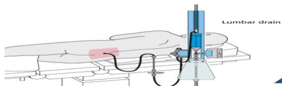 ELD (External lumbar drain)