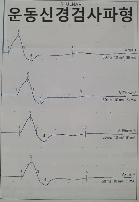신경전도검사 Ulnar Nerve척골신경 검사방법 피할 수 없으면 즐기자