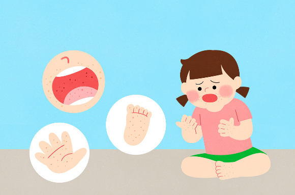 수족구 증상 수족구병 예방 조치 총정리