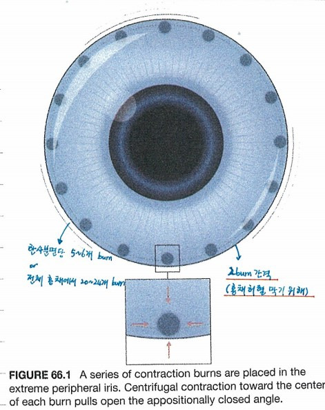 아르곤 레이저 주변홍채 성형술(Argon Laser Peripheral iridoplasty, ALPI, LPI, Argon ...