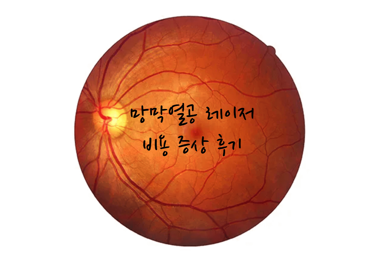 망막열공 레이저 비용 증상 후기