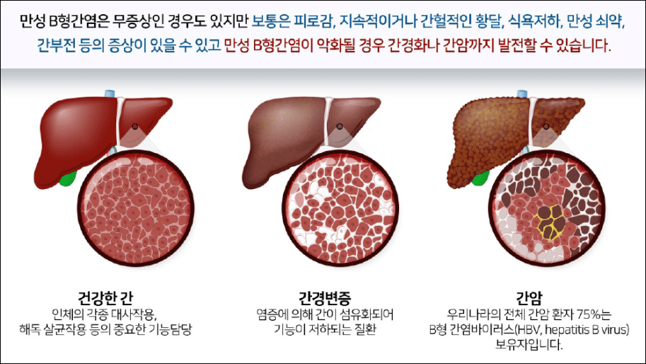 B형 간염 증상 원인 진단 치료 예방 방법