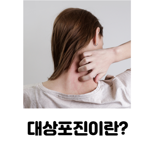 대상포진 발생 원인 초기 증상 치료 합병증 및 예방 접종 가격 총정리