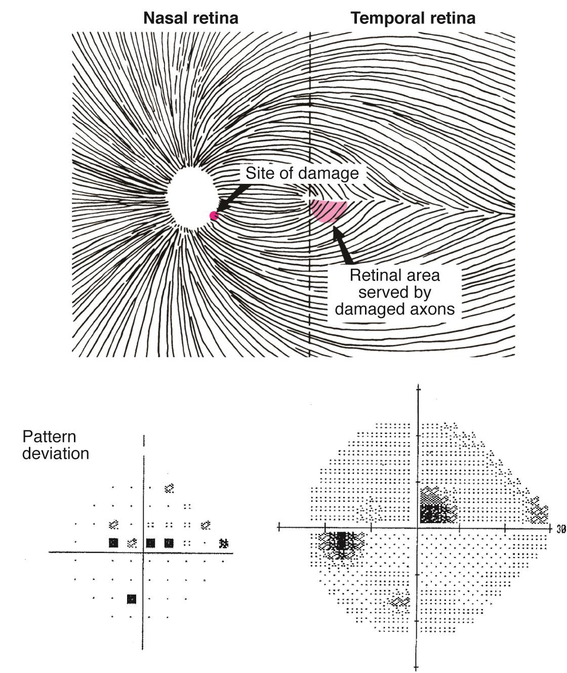 녹내장 시야 : 산란, 비에룸영역, 중심부근암점, 활모양암점, 자이델암점, 고리결손