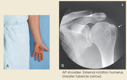 일반촬영 x-ray 엑스레이 어깨(shoulder series) - shoulder AP 촬영방법