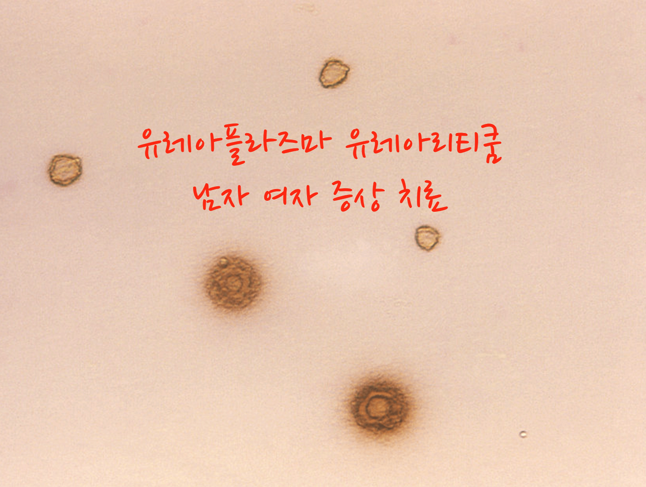 유레아플라즈마 유레아리티쿰 남자 여자 증상 치료
