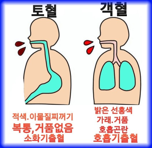호흡기 질환 객혈 종류 원인 증상 진단방법 치료방법