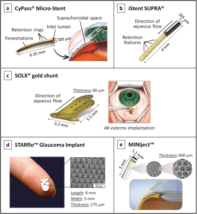 방수유출장치 Glaucoma Drainage Device / Implant, GDD, GDI 종류, Krupin, Ex ...