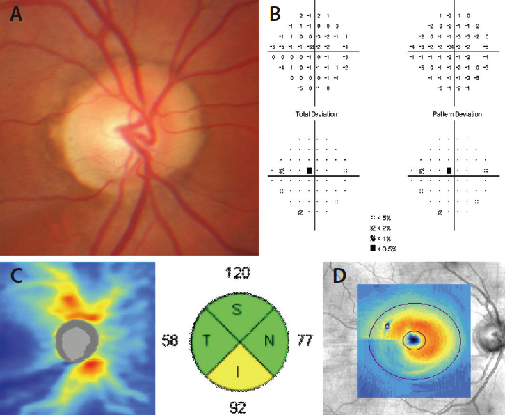 녹내장 망막신경섬유층 RNFL, Retinal nerve fiber layer 구조 대사, 손상